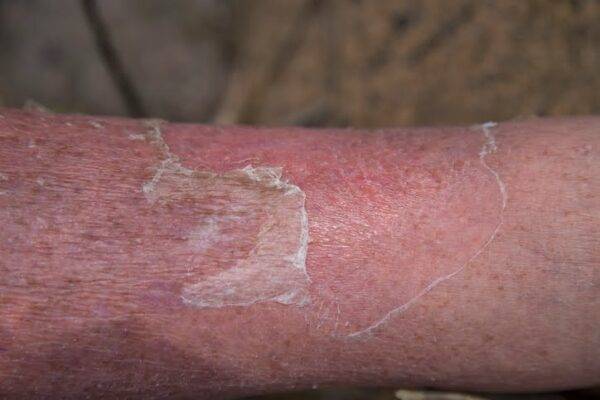 Understanding Cellulitis in Cancer Patients